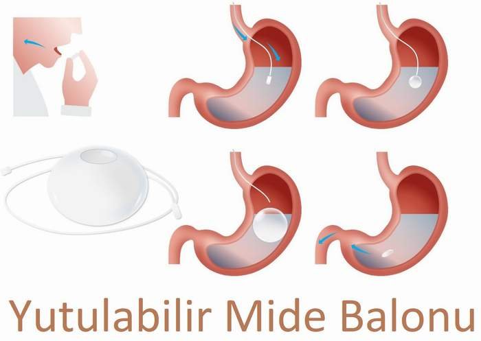 Yutulabilir Mide Balonu Fiyatları 2024