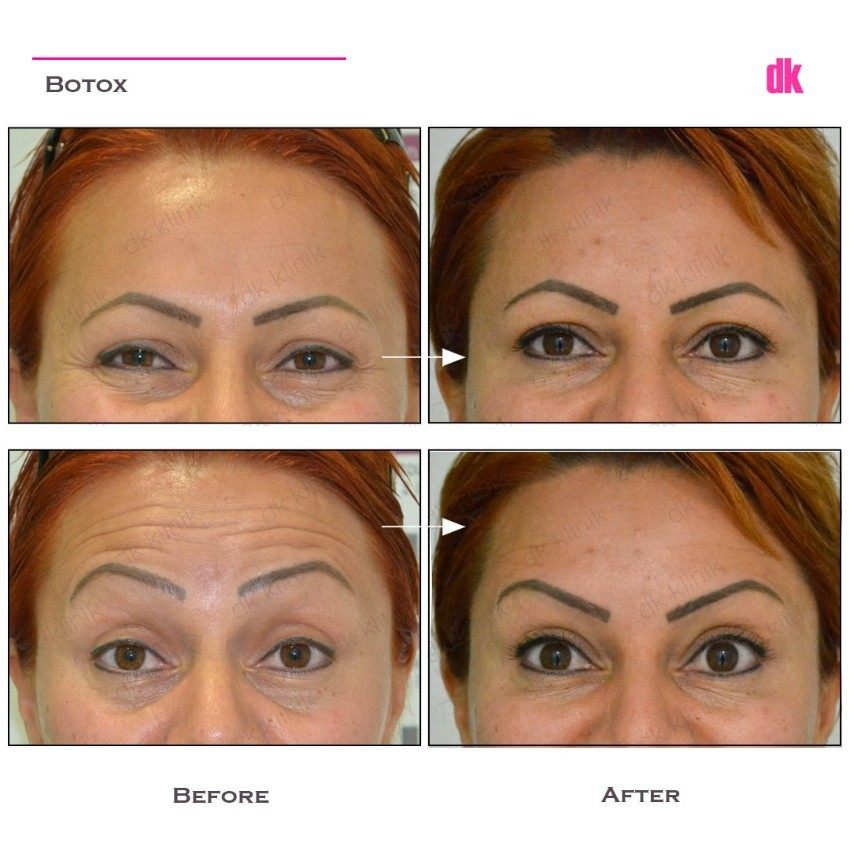 BOTOX - Forehead - Before and After Gallery