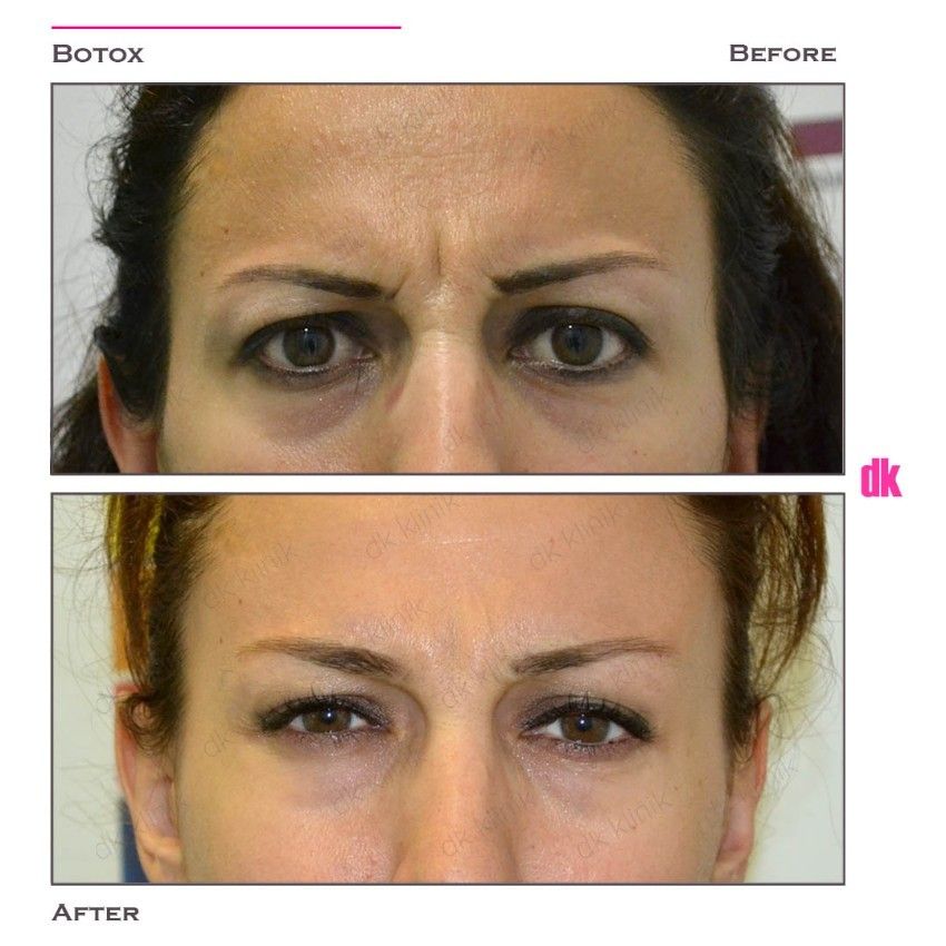 BOTOX - Frown Lines - Before and After Gallery