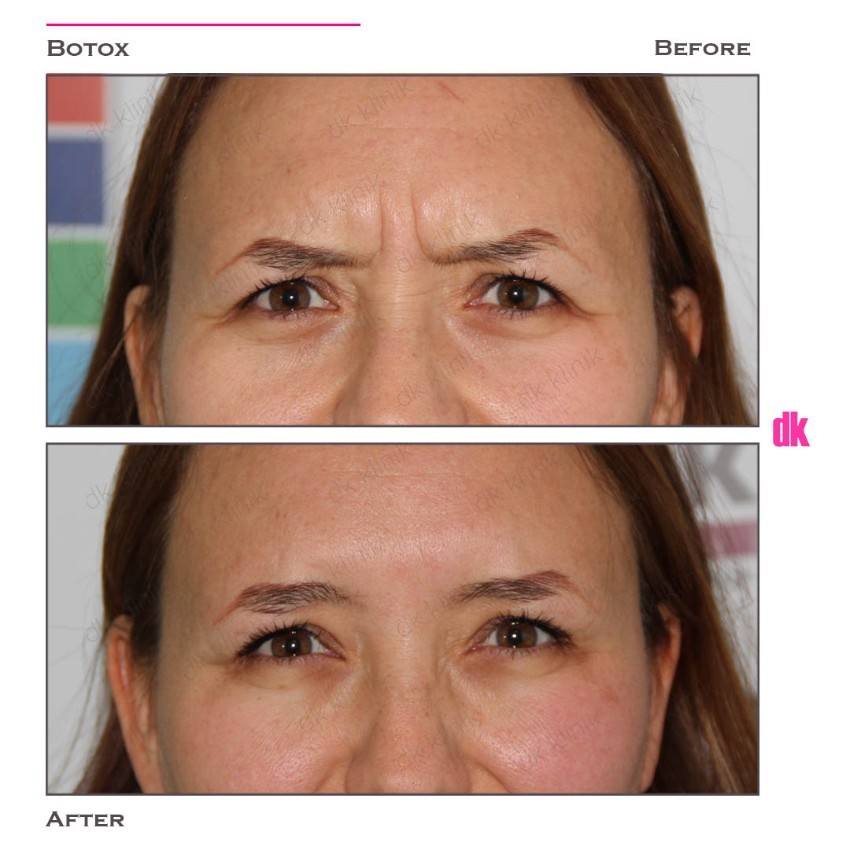 BOTOX - Frown Lines - Before and After Gallery