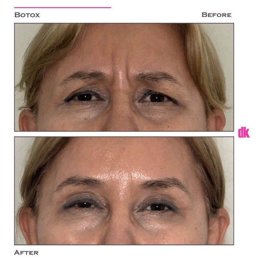 BOTOX - Frown Lines - Before and After Gallery