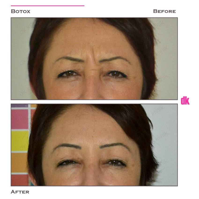 BOTOX - Frown Lines - Before and After Gallery