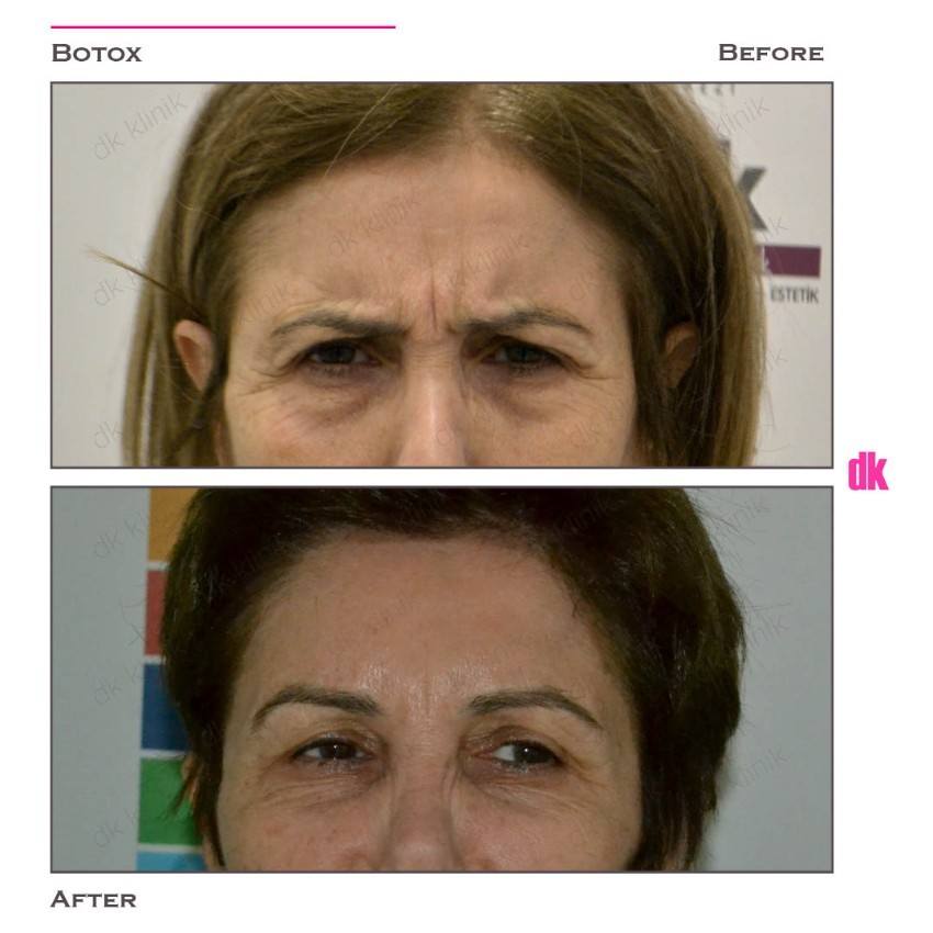 BOTOX - Frown Lines - Before and After Gallery