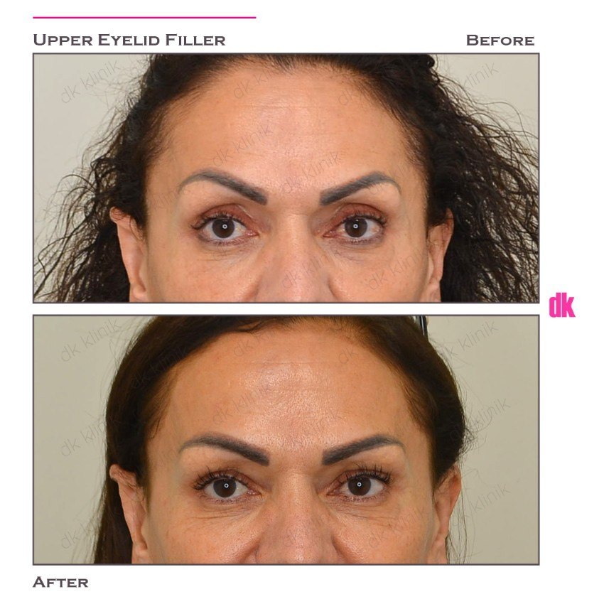 FILLER- Around Mouth - Before and After Gallery