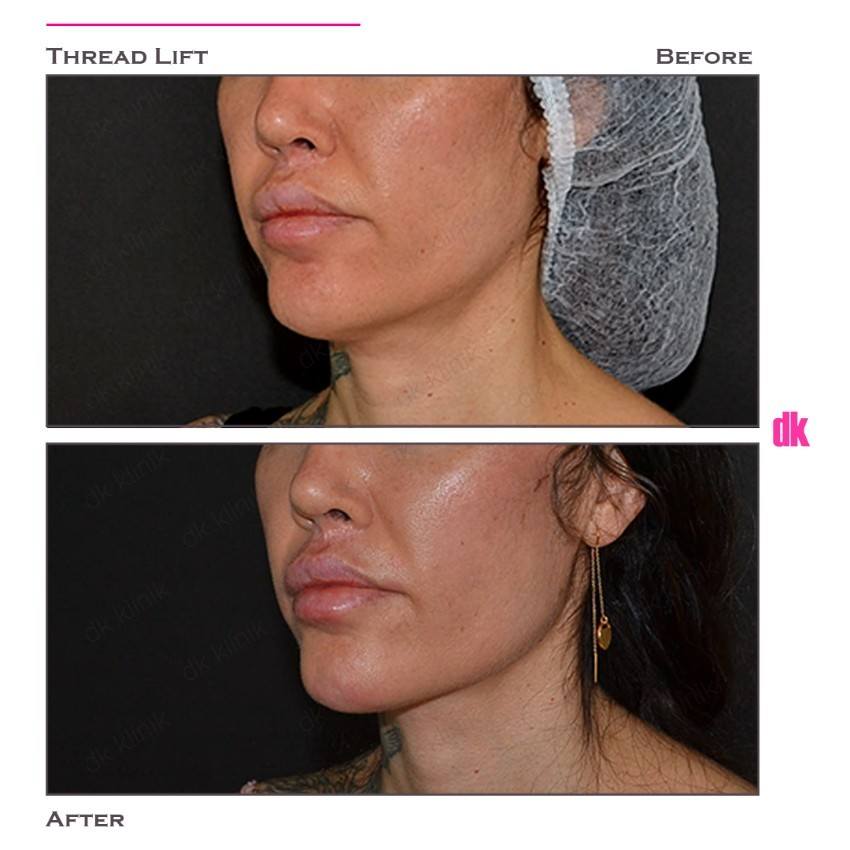 THREAD LIFT- Before and After Gallery
