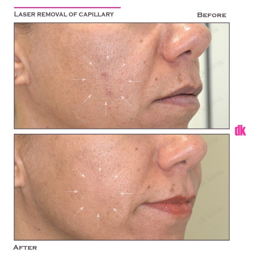 LASER TREATMENT OF CAPILLARY - Before and After Gallery