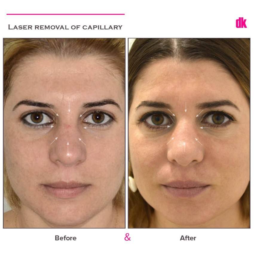 LASER TREATMENT OF CAPILLARY - Before and After Gallery