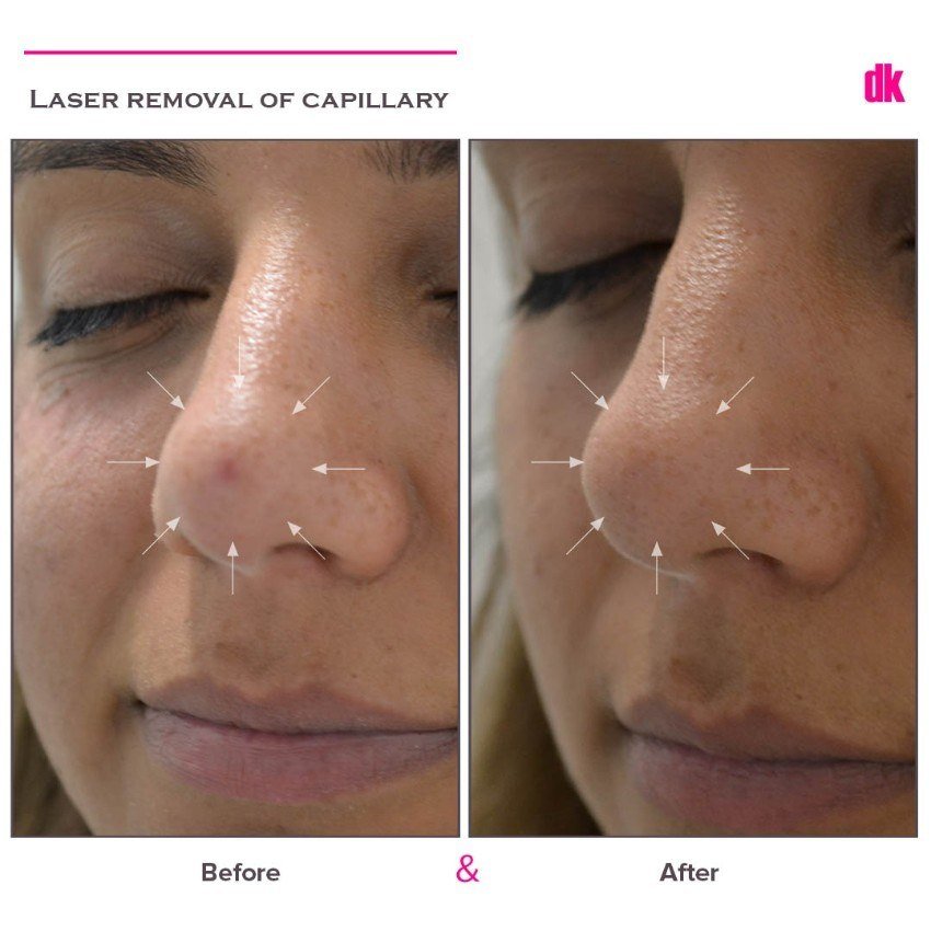 LASER TREATMENT OF CAPILLARY - Before and After Gallery