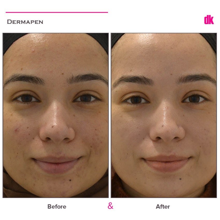 DERMAPEN - Before and After Gallery