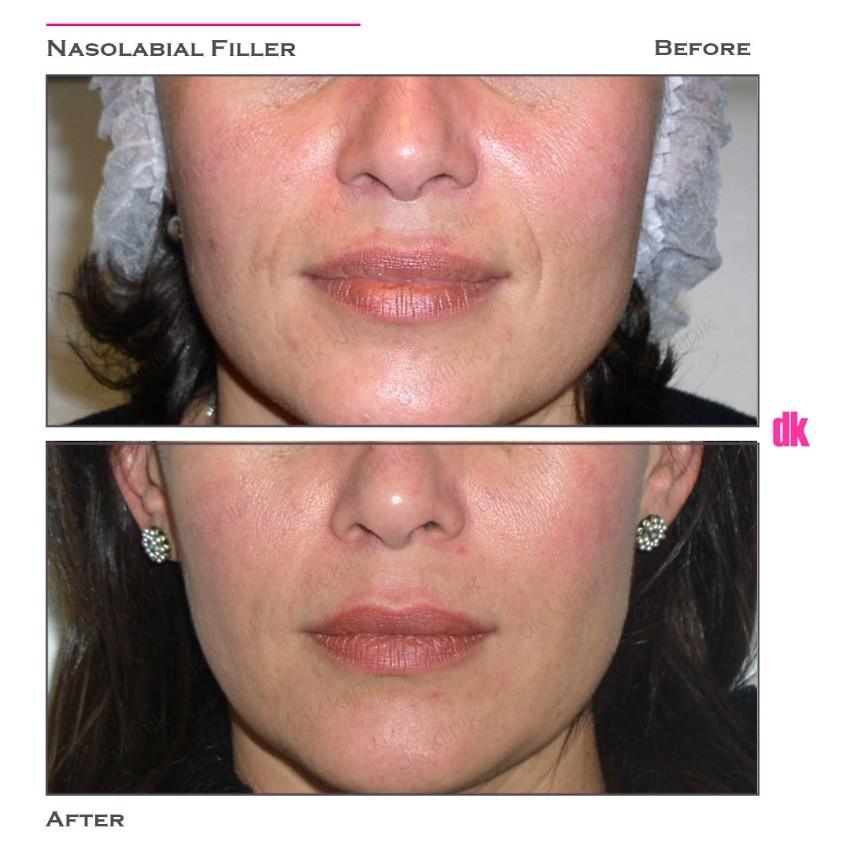 FILLER- Nasolabial Fold - Before After