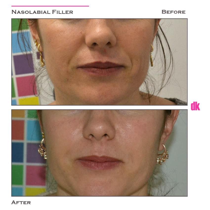 FILLER- Nasolabial Fold - Before After