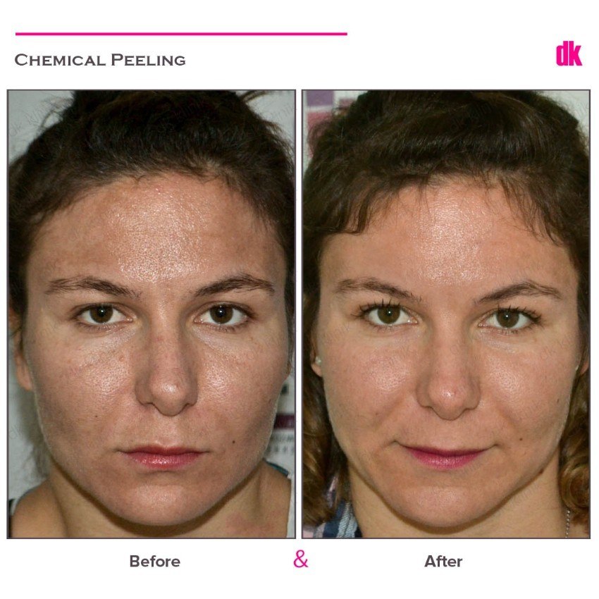 CHEMICAL PEELING - Before and After Gallery