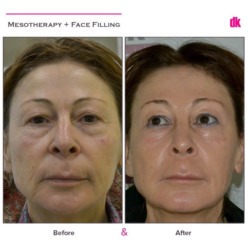 MESOTHERAPY - Before and After Gallery