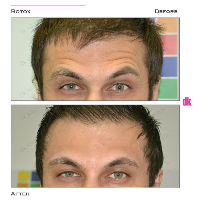 BOTOX-Male-Before and After Gallery